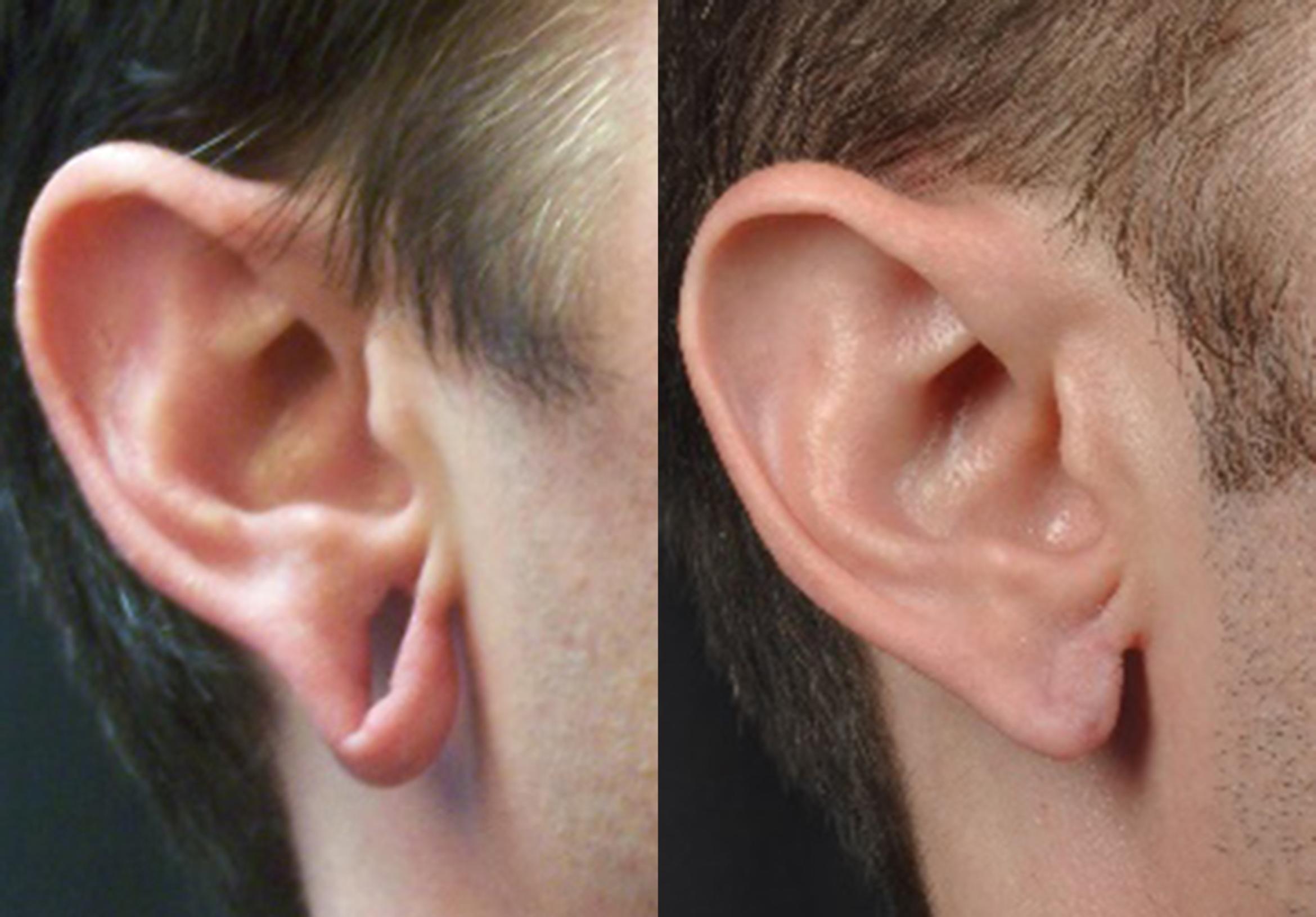 Earlobe Repair Before and After Pictures Case 4479 | Virginia Beach, VA ...